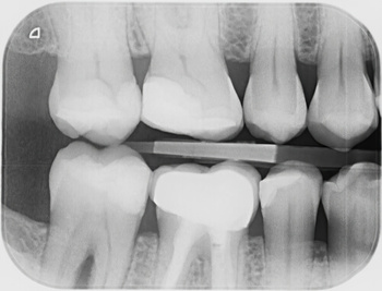 Cavity Cracked Tooth | Maroondah Dental Care